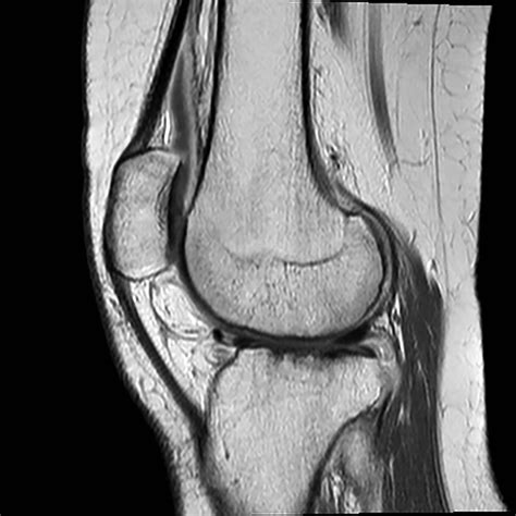 Osteoarthritis Knee Mri Imaging Of Osteoarthritis Of The Knee