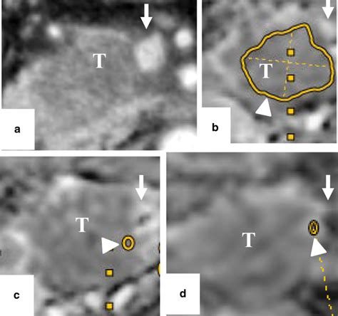 Computed Tomography CT Imaging And Apparent Diffusion Coefficient Download Scientific Diagram