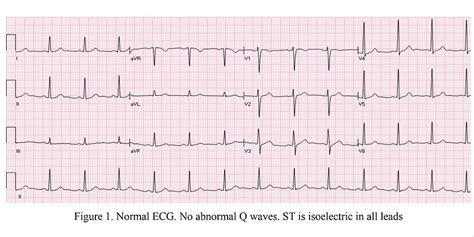 Normal Ecg Hd Wallpaper Pxfuel 53 Off Brunofuga Adv Br