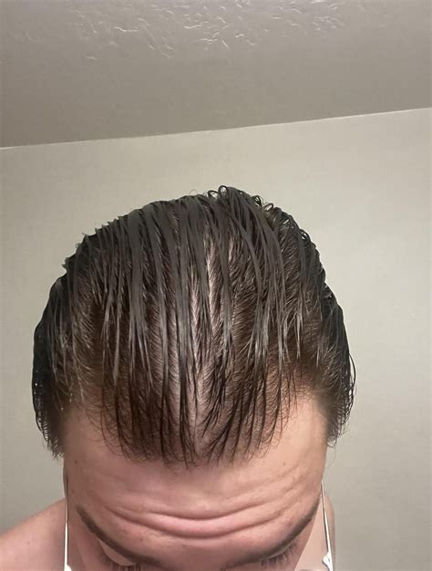 Diffuse Thinner 5 Months Into 25mg Oral Minoxidil Already On 1mg