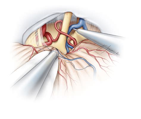 Geniculate Neuralgia The Neurosurgical Atlas