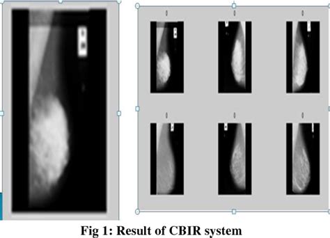Figure 1 From Ann Based Classifier System For Digital Mammographic Images Semantic Scholar