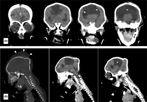 Non‐contrast Ct Scan Of The Brain In Coronal A And Sagittal B Views