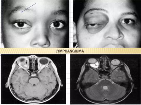 Evaluation Of Proptosis Pptx