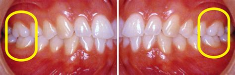 Dental Anatomy Functional Occlusion Flashcards Quizlet