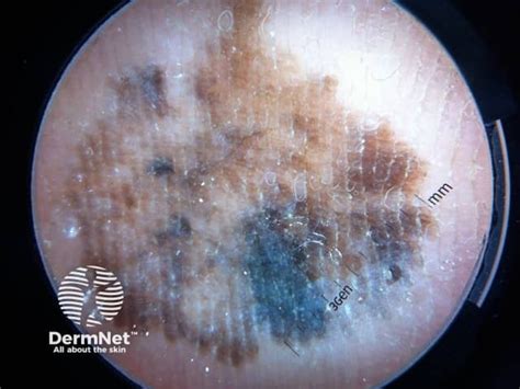Acral Lentiginous Melanoma Images — Dermnet