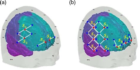Motion Artifact Detection And Correction In Functional Near Infrared Spectroscopy A New Hybrid