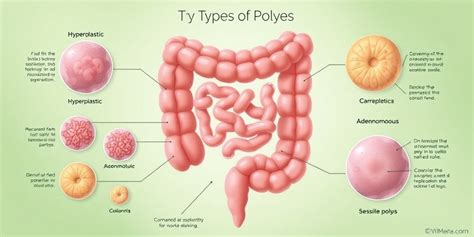 Polyp Understanding Types Symptoms And Treatments • Yesil Health Ai