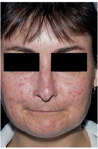 Systemic Sclerosis Flashcards Quizlet