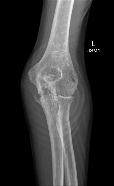 Elbow Joint Xray Radiopaedia