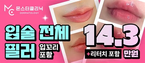 입술 입꼬리 전체필러 뀨x By 몬스터의원 강남언니 1등 성형수술and피부시술 정보앱