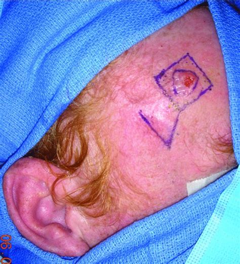 4 Rhomboid Flap Pocket Dentistry