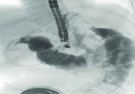 Gastrojejunostomy Is Completed Contrast Medium Passes Through The