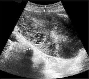Massive Ovarian Edema In A 13 Year Old Girl With Amenorrhea Acne
