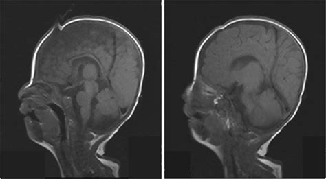 Mri Image Of Head Persistent Falcine Sinus And A Thin Corpus Callosum
