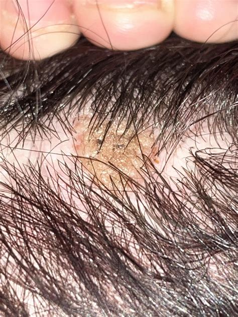 Scalp Lesion Rdermatologyquestions Scalp Lesion Rdermatologyquestions
