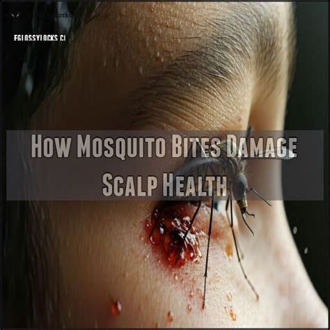Can Mosquito Bite Your Scalp 7 Warning Signs And Fast Relief Methods