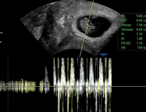 임신 7주차 아기의 쿵쾅쿵쾅 심장소리를 듣다