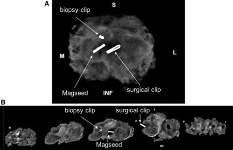 Effectiveness And Safety Of Magseed Localization For Excision Of Breast Lesions A Prospective Effectiveness And Safety Of Magseed Localization For Excision Of Breast Lesions A Prospective