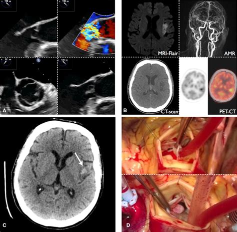 Surgical Management Of Infective Endocarditis Complicated By Embolic
