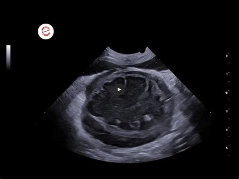 Neoplastic Infiltrative Process Esaote