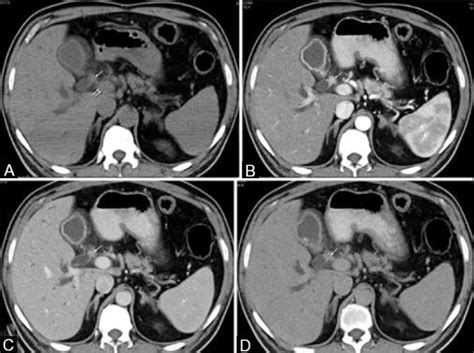 Hilar Cholangiocarcinoma Cross Sectional Evaluation Of Disease