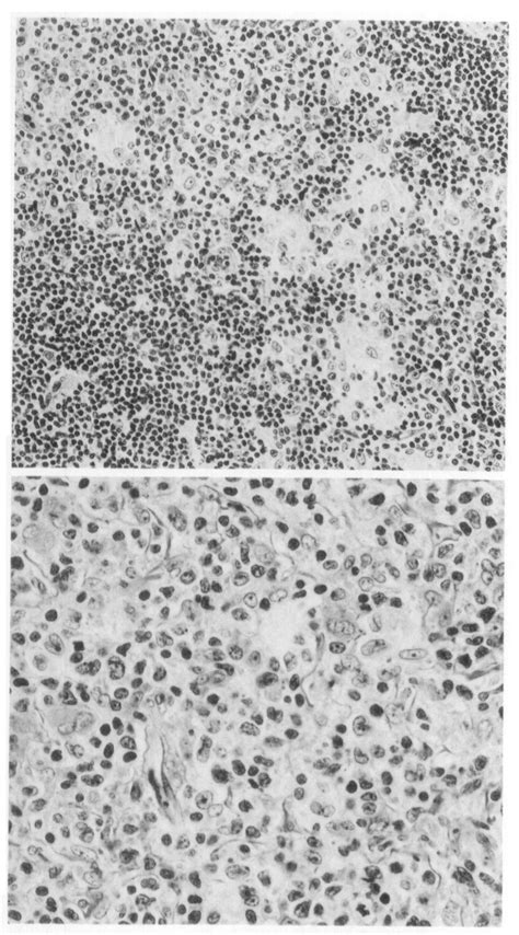 Upper A Diffuse Mixed Cell Lymphoma Case 10 With An Epithelioid Download Scientific