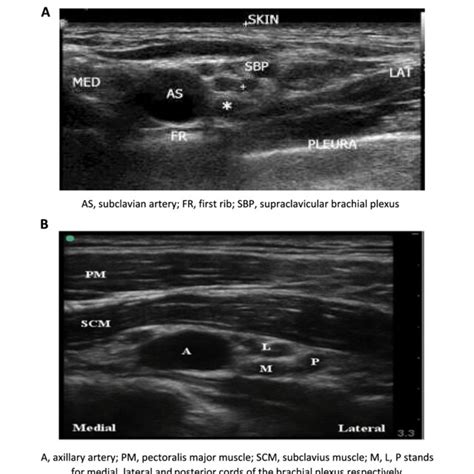 A Ultrasonography Image For Supraclavicular Brachial Plexus Block Download Scientific Diagram