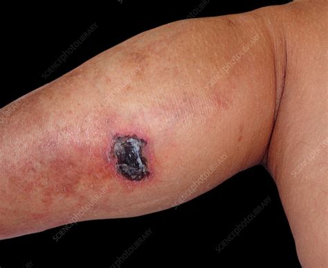 Pyoderma Gangrenosum Stock Image C032 0477 Science Photo Library