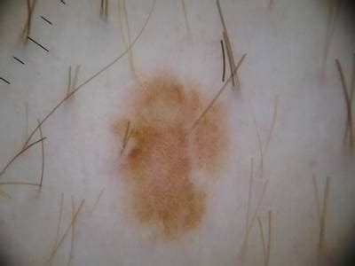 ISIC Challenge 2018 Dataset Ninja