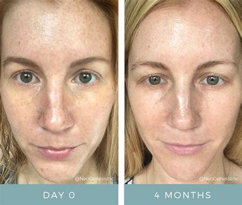 Hyperpigmentation Skin Care Product Before After