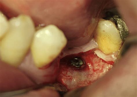 Implanted Site Is Exposed After 9 Weeks And Clinical Bone Defects Are Download Scientific