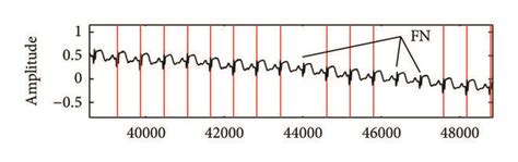 A Detected Qrs Complex Of Ecg Data Record S0020arem Lead Avf