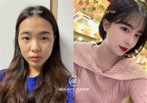 Epicanthoplasty And Its Differences From Other Eyelid Surgeries Ab