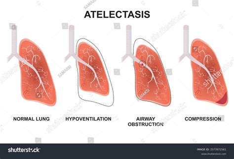Types Atelectasis Over 1 Royalty Free Licensable Stock Illustrations And Drawings Shutterstock
