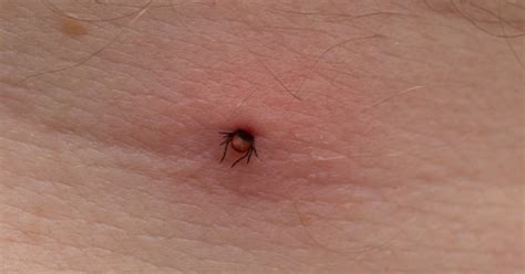 등산 즐기고 주말농장 운영한다사람 무는 진드기 조심