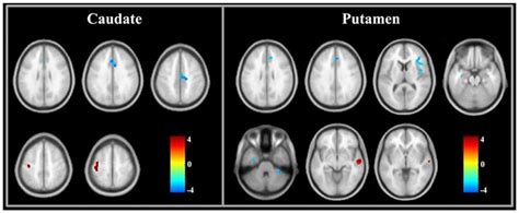 Brain Regions Showing Significant Differences In Corticostriatal