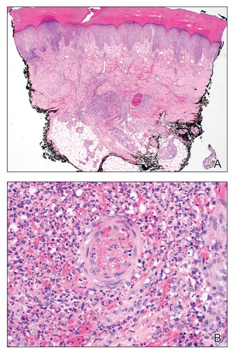 Fungal Osler Nodes Indicate Candidal Infective Endocarditis Mdedge