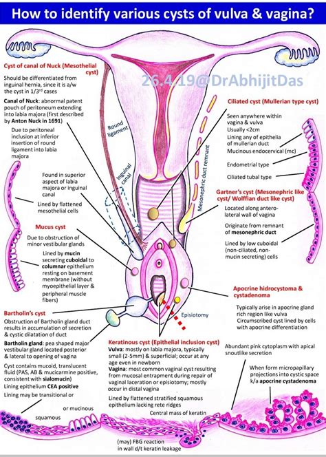 Vestibular Gland Cyst