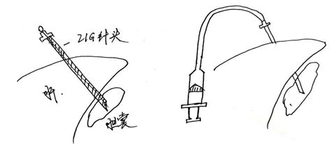 胆囊造瘘如何做?一文帮你搞定 搜狐大视野 搜狐新闻 胆囊造瘘如何做?一文帮你搞定 搜狐大视野 搜狐新闻
