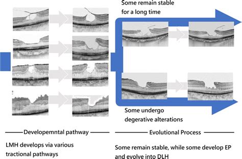 The Proposed Developmental Pathway And Evolutional Processes Of LMH And Download Scientific