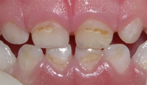 Faq Can Babies Get Cavities — Discovery Pediatric Dentistry