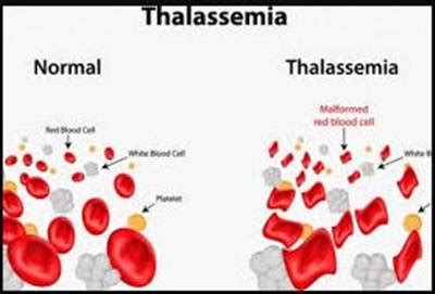 Kelainan Pada Sel Darah Merah Eritrosit Your Chemistry A