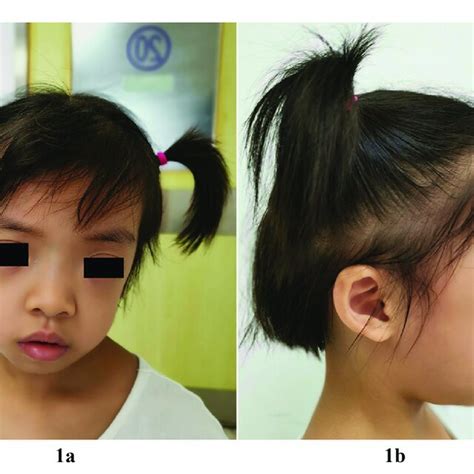 Pdf Case Report A De Novo Rasopathy Causing Shoc2 Variant In A Chinese Girl With Noonan