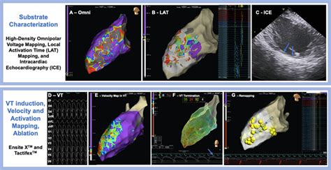 First In Human Endocardial Catheter Ablation Of Vt Using A Novel Download Scientific Diagram