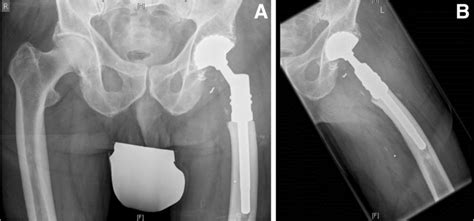 A And B Radiographs Showing The Typical Post Operative Findings Download Scientific Diagram
