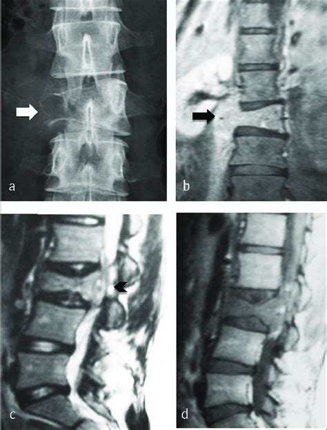 Ewings Sarcoma X Ray