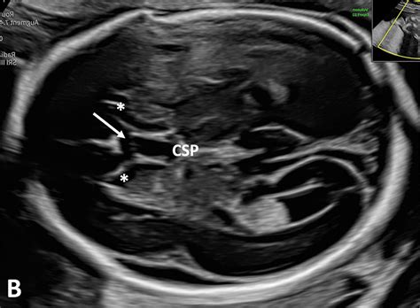 Normal Fetal Brain Ultrasound Normal First Trimester Anatomy Of The