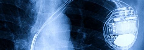 Active Implantable Medical Devices Bsi America