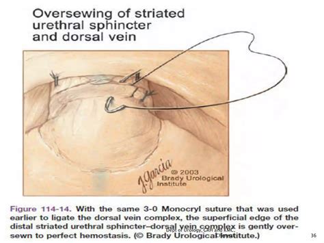 Prostate Carinoma Surgery Open Radical Retropubic Prostatectomy Rrp Pdf